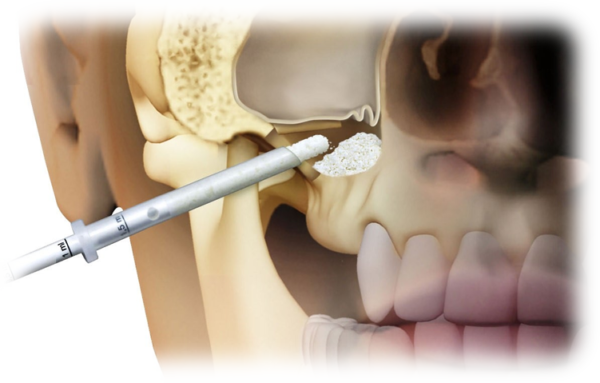 Sinus Lift Surgery | Sinus Shift Surgery Miami Springs, FL