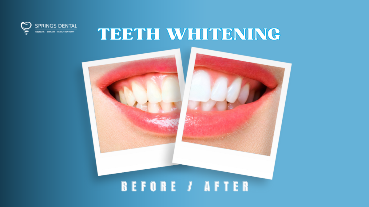Teeth Whitening in Miami Springs, FL